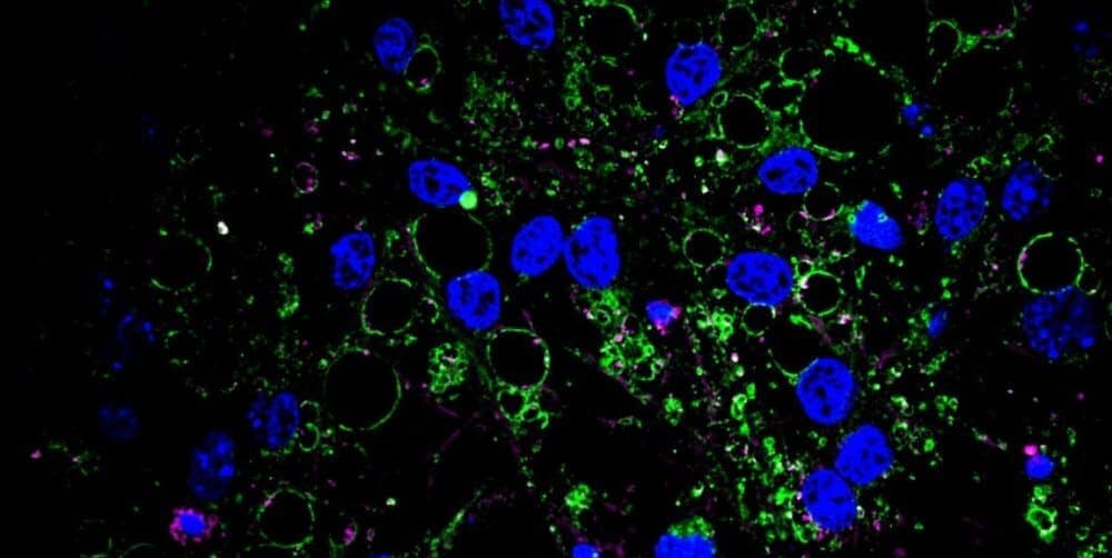 Clearing clumps of protein in aging neural stem cells boosts their ...