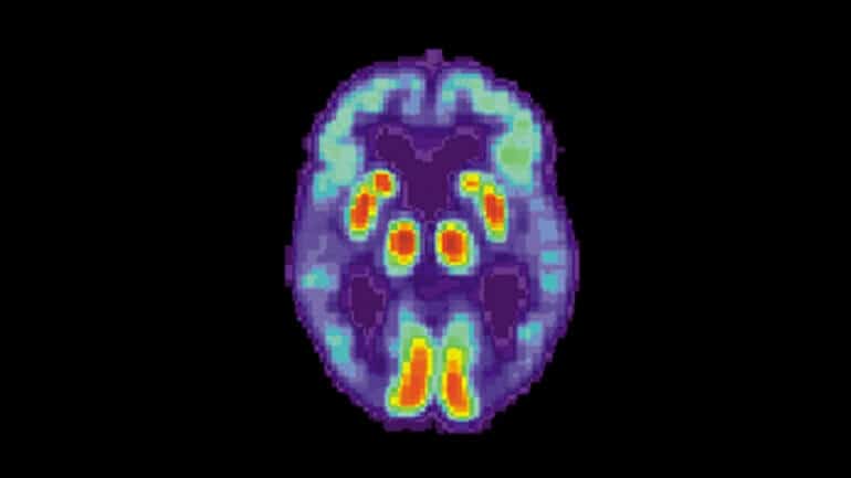 Artificial Intelligence Can Detect Alzheimer’s Disease in Brain Scans ...