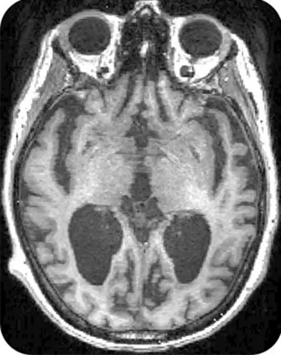 The Brain's Rotten-Egg Gas May Be Key to Stopping Memory Loss ...