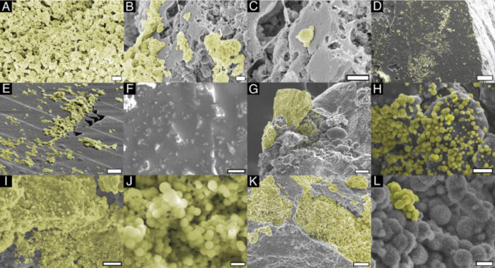 Most Kidney Stones May Actually Be Bacterial Colonies - ScienceBlog.com